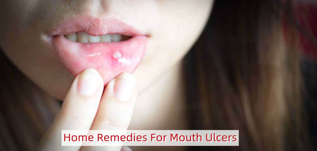 Natural Remedies To Cure Mouth Ulcers At Home Shanghai Medical Clinic