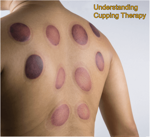 Cupping Therapy: Benefits And What To Expect | Shanghai Medical Clinic
